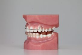 Soorten beugels | Ortho aan de Zaan