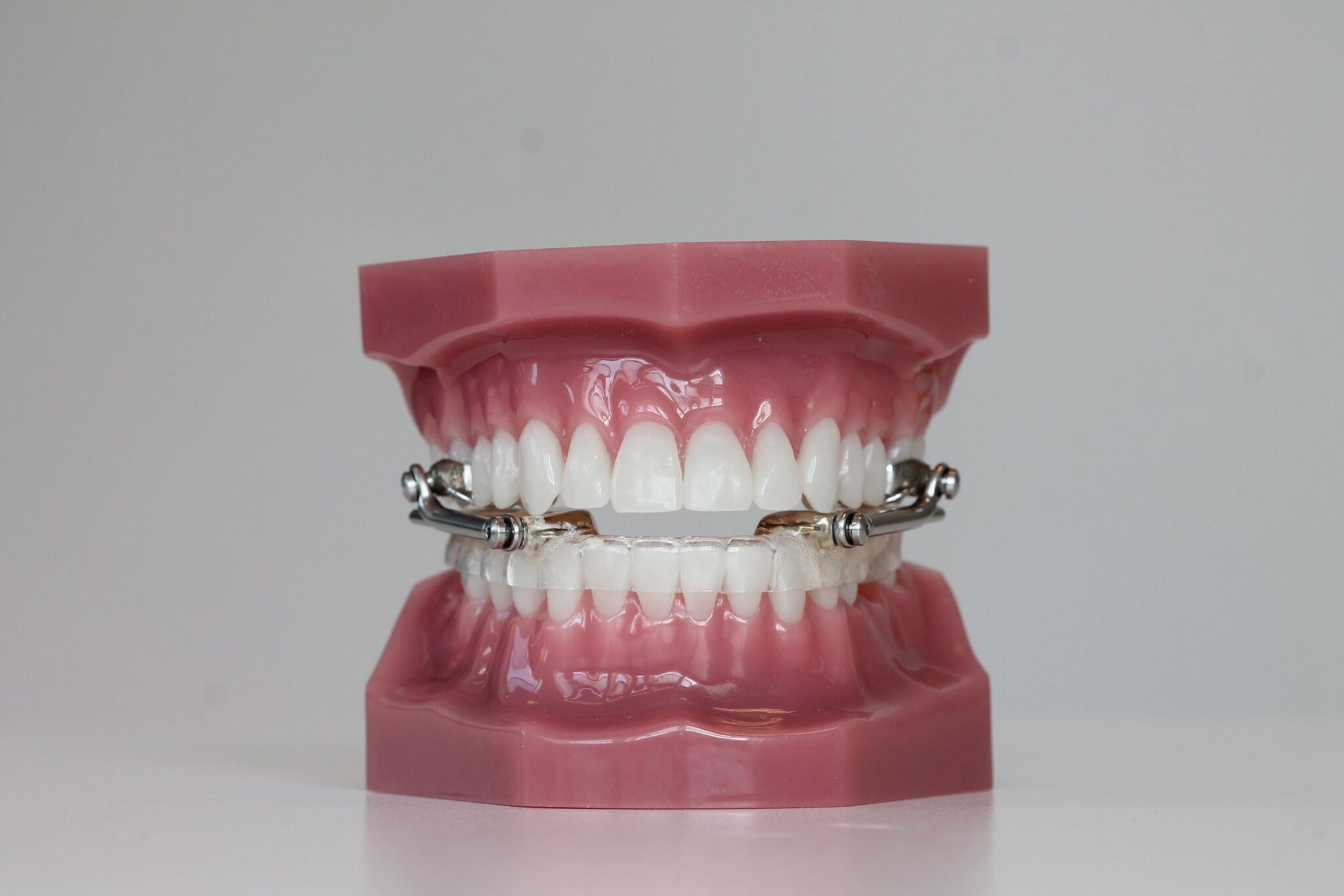 Soorten beugels | Ortho aan de Zaan