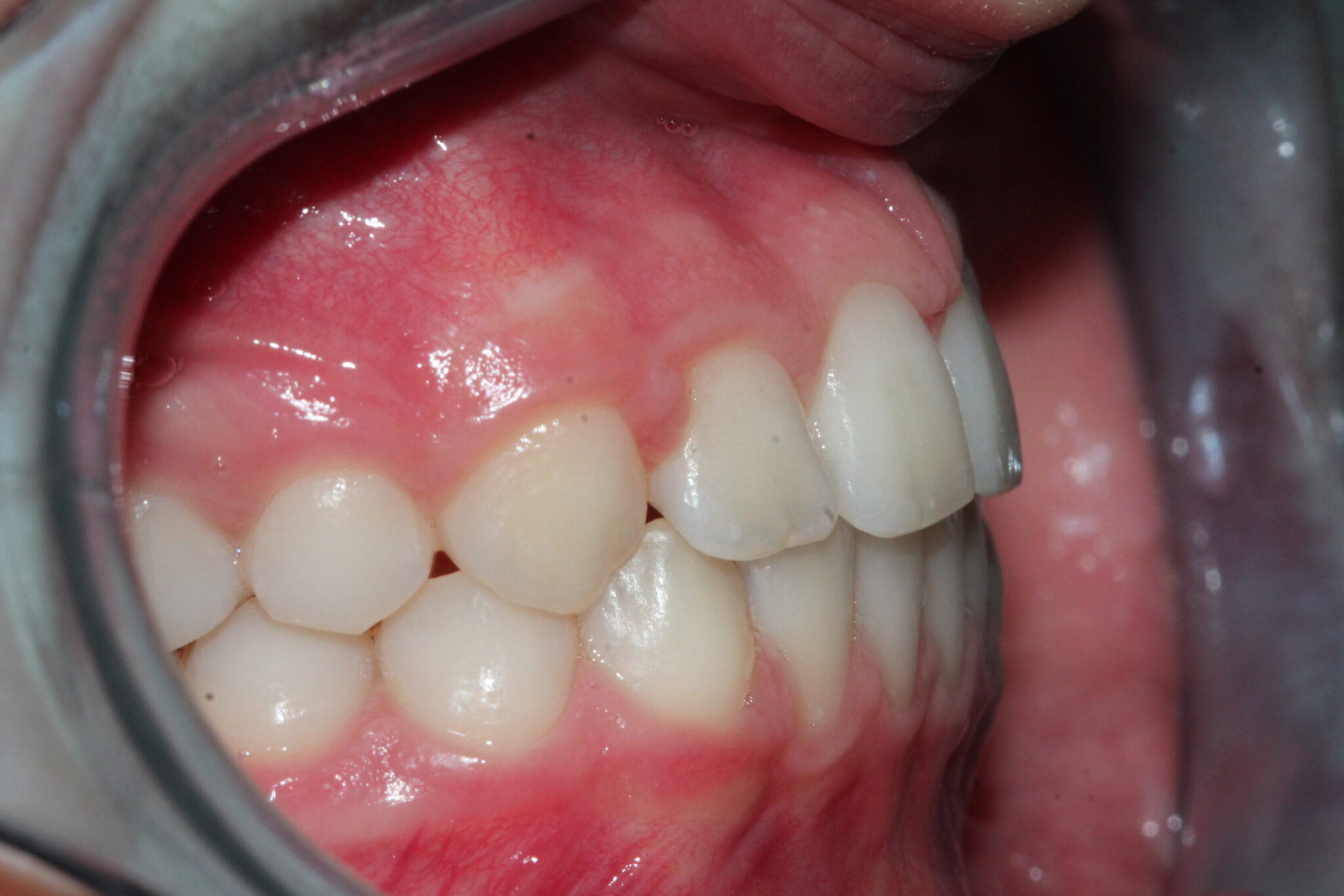 Soorten beugels | Ortho aan de Zaan