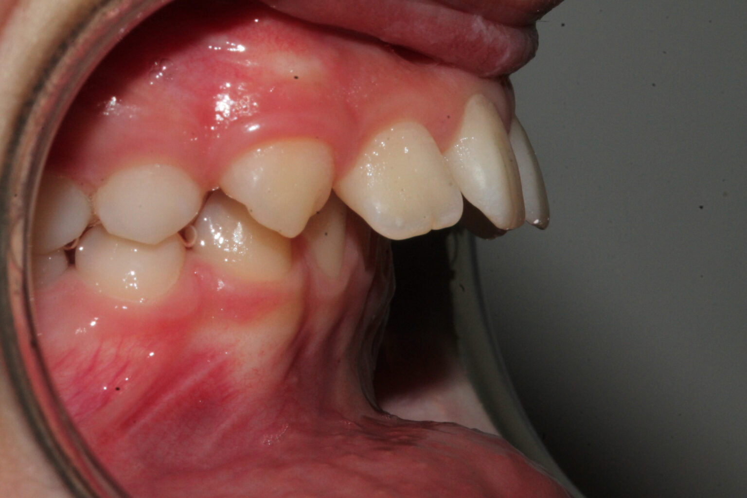 Soorten beugels | Ortho aan de Zaan