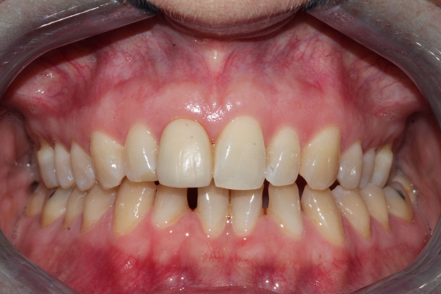 Soorten beugels | Ortho aan de Zaan