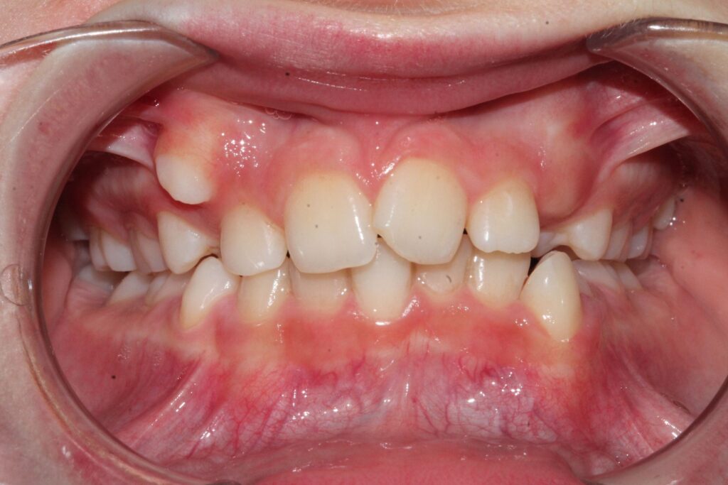 Een beugel laten plaatsen | Ortho aan de Zaan Een beugel laten plaatsen | Ortho aan de Zaan