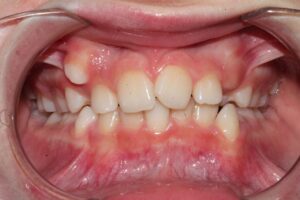 Soorten beugels | Ortho aan de Zaan